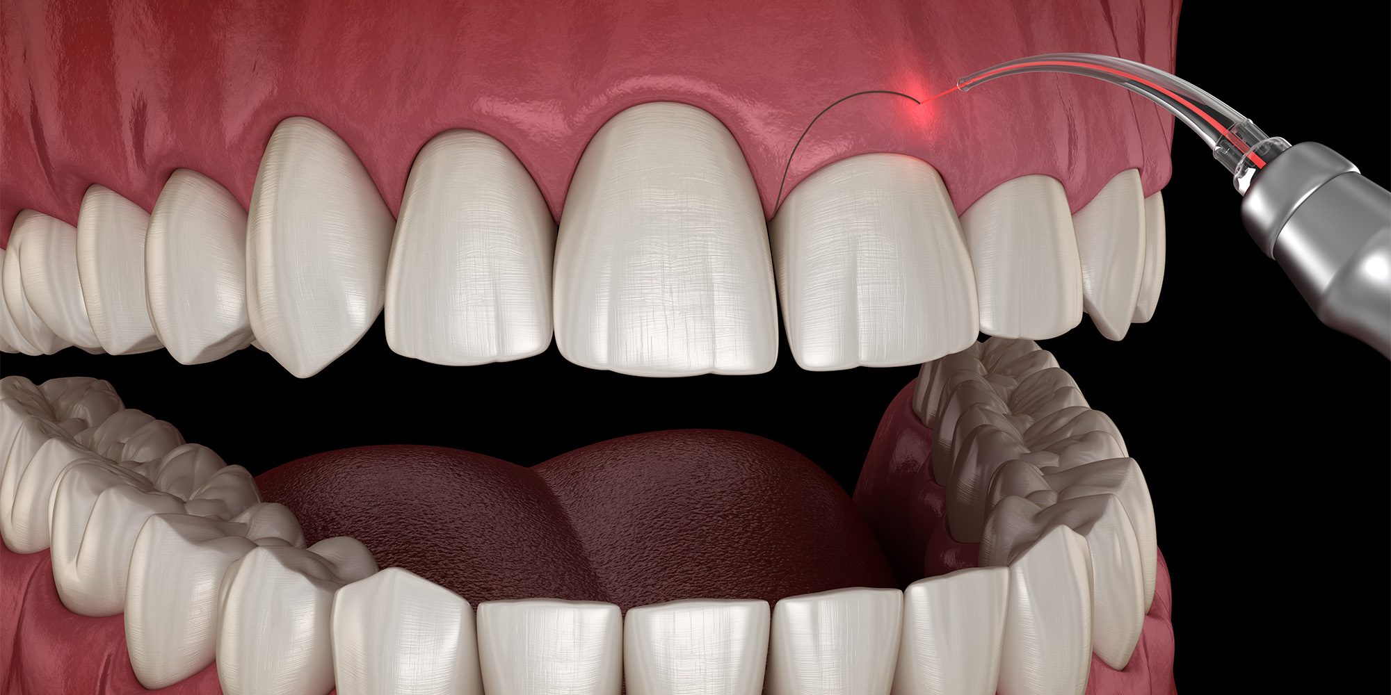 Dental Crown Lengthening Seminole, FL | NuSmile Dental